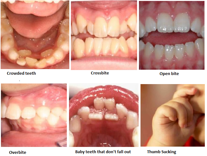Common Orthodontic Problems to Look Out for in Children - Manning ...